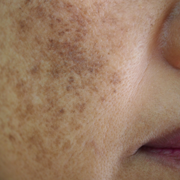Personalised, Results Focused, No Fluff Facial Treatments – Bare Skin ...