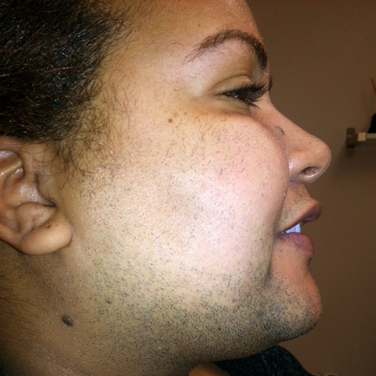 Laser Hair Removal – Bare Skin Facial + Laser Bar